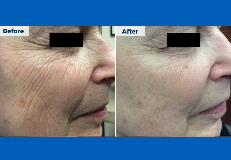 Laser Skin Rejuvenation National Skin Cancer Centres